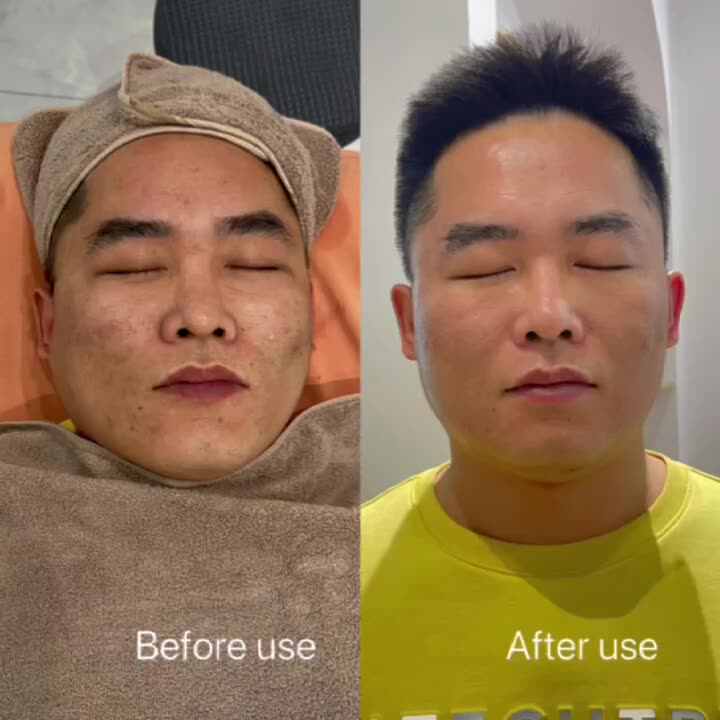 BIO Microneedling Sponge - Fast Pore Shrink & Acne Treatment