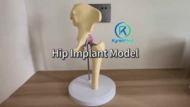 KyrenMed Hip Implant Model Artificial Hip Joint Replacement Model Life ...