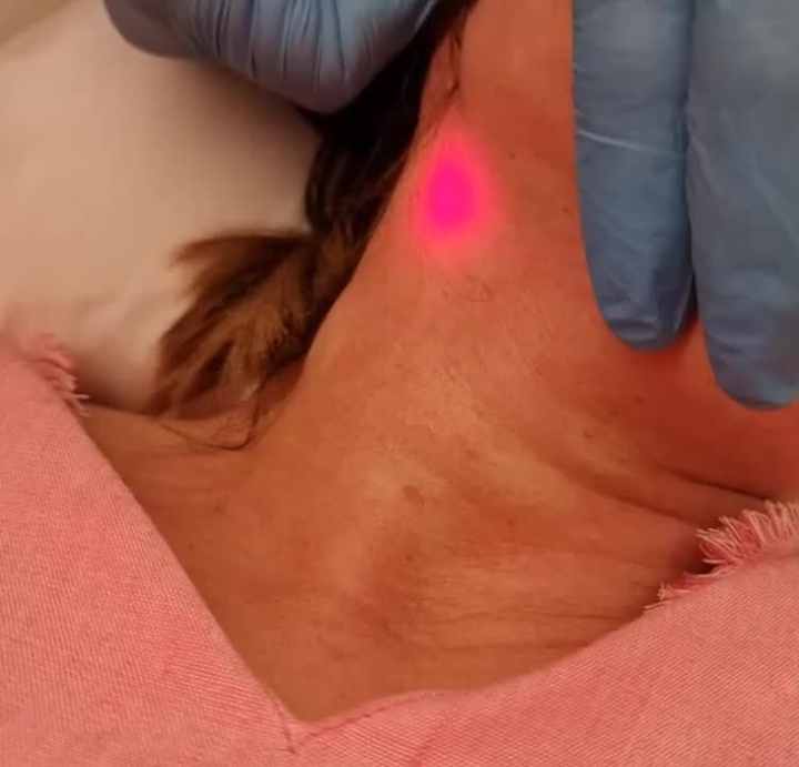 Sculptra BBL Buttock Filler Laser 980nm Lipo 1470nm full-face lift ...