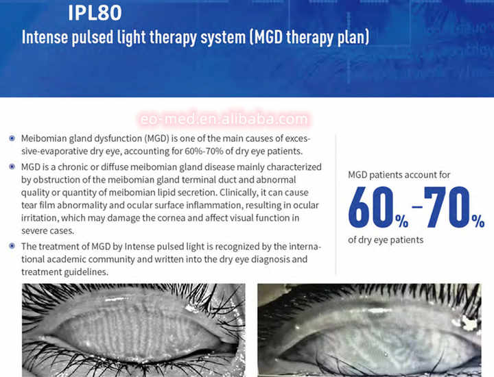 IPL80 Ophthalmic Device Meibomian Gland Dysfunction Machine to Treat ...