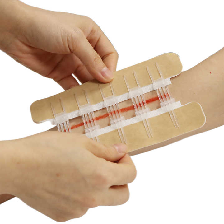 BLUENJOY Sterile Skin Color Wound Closure Device - Zip Stitch Wound Care