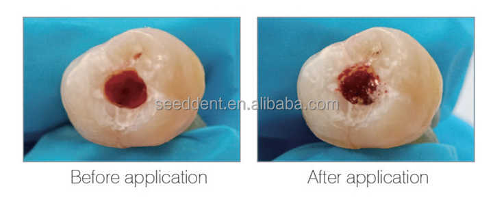 Root Canal Gel EDTA Lubrication Helps to Expand Root Canals Dental Composite Material| Alibaba.com