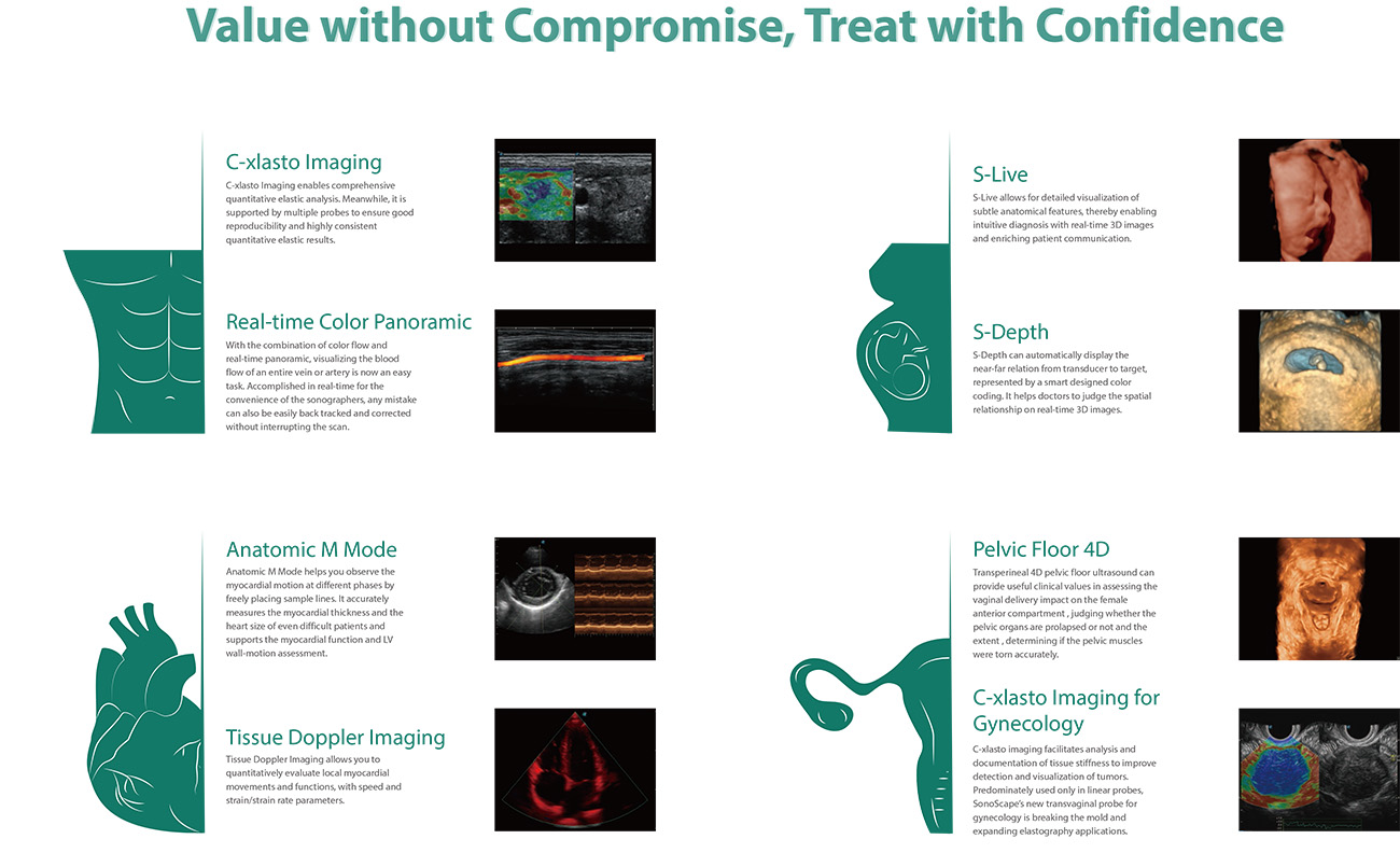 Sonoscape P20 3D |4D | 5D Ultrasound Color Doppler