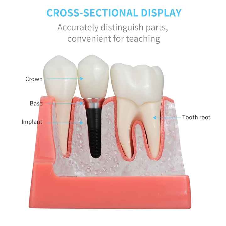 SJ Dental Implant Model 4 Times Removable Analysis Crown Bridge Manual ...