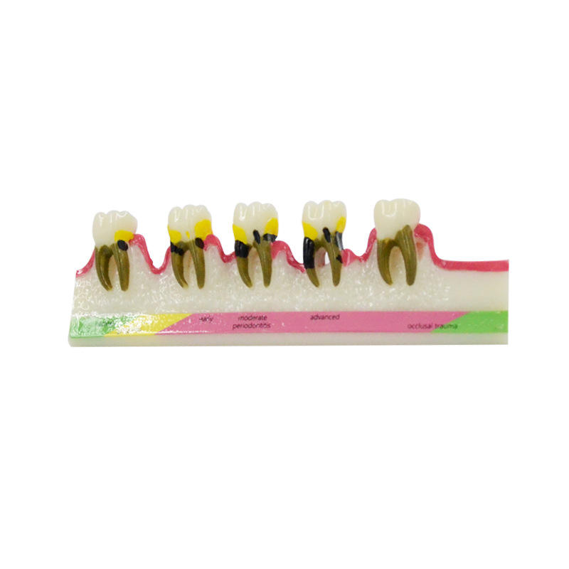 Educational Equipment Periodontal Disease Model for Demonstration and ...