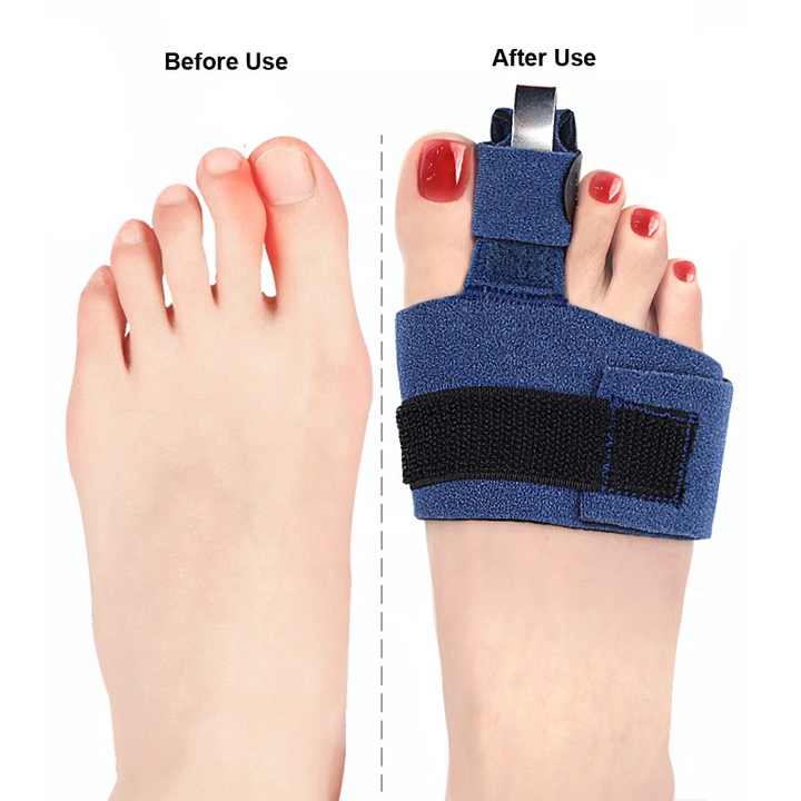 Toe Splints Adjustable Adult Bent Toe Immobilization Splint Metal ...