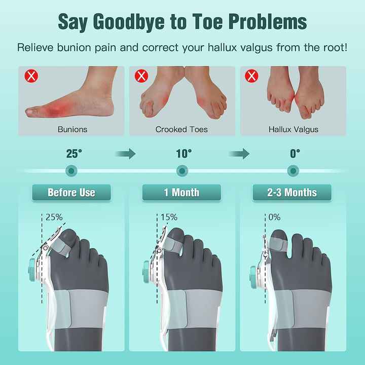 New Arrival Adjustable Big Toe Splint Foot Bone Protrusion Overlapping ...