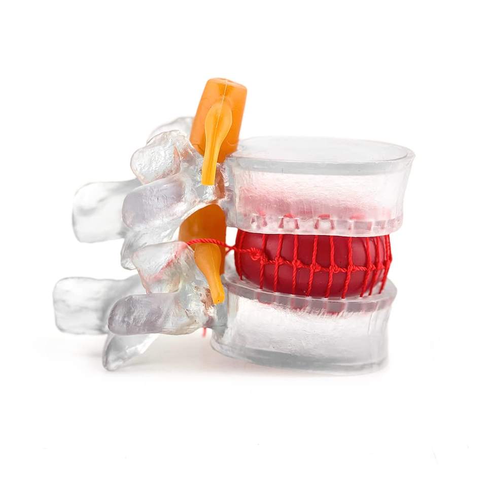1.5X Life-Size Lumbar Herniated Disc Medical Model Vertebral Spine ...