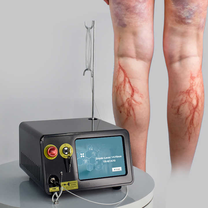 EVLT / EVLA 1470 Diode Laser for Varicose Veins Treatment