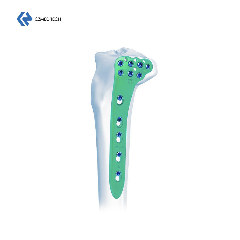 How to Choose the Right Proxima Tibial Plate: A Complete Buying Guide