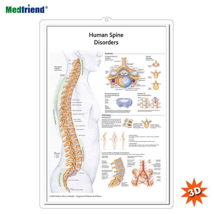 3D Medical Human Anatomical Wall Chart / Poster - Human Spine Disorders ...