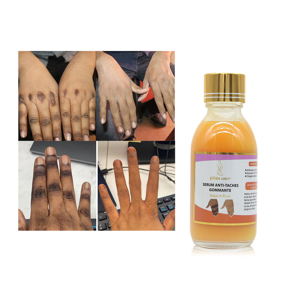 Private Label Fast Whitening Serum Dark Knuckles Pigmentation Hand ...
