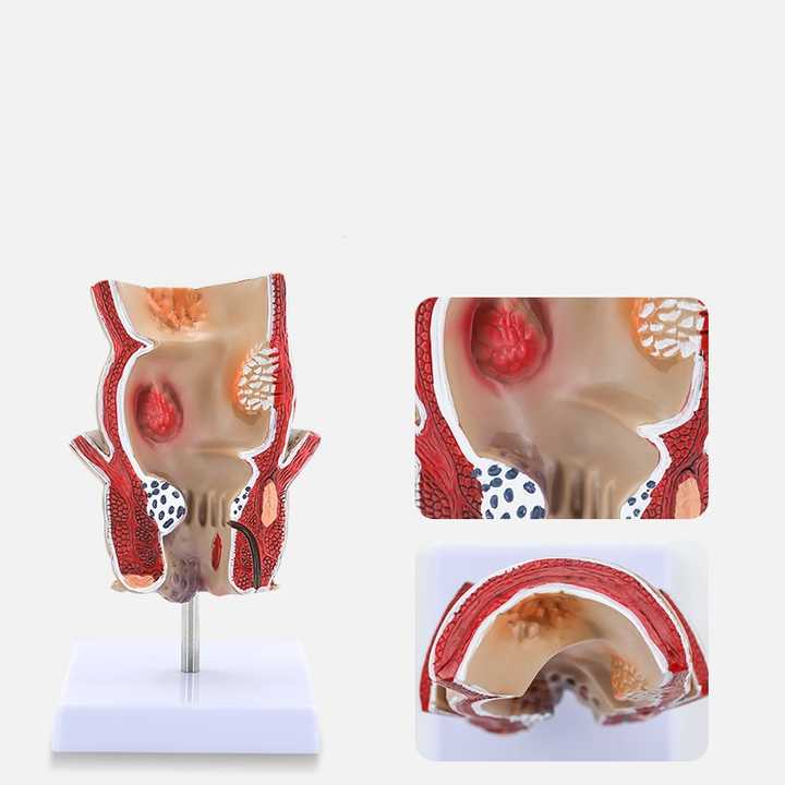 Rectal Hemorrhoids Colorectal Disease Model Internal And External