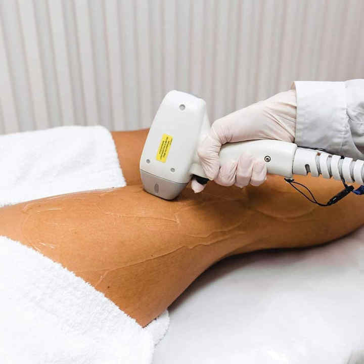 Lumenis Lightsheer 808nm Diode Laser Hair Removal Machine