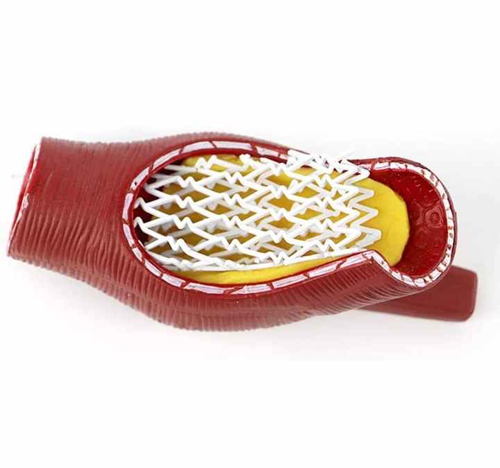 KyrenMed Human Vascular Stent Model Coronary Artery Cardiovascular ...