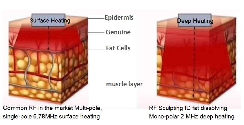 2022 Latest Full Body Fat Removal Machine Warm RF Sculpting TruSculpt 3D Tru Sculpt ID RF Monopolar Therapy