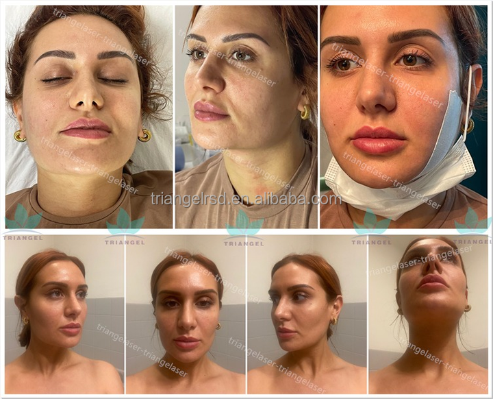 Vaser Liposuction Surgery Machine - 980nm Diode Laser