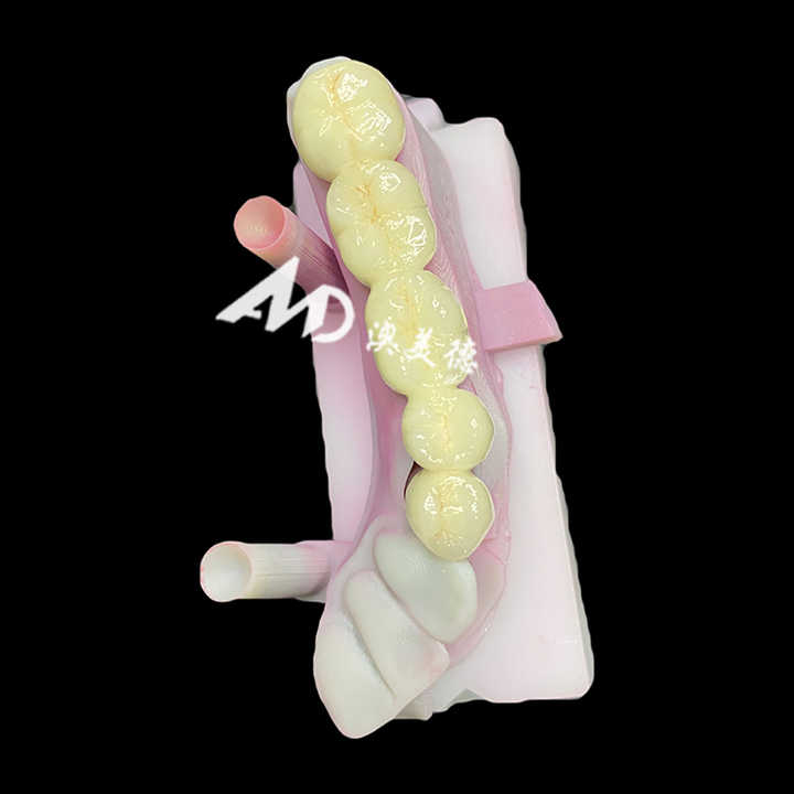 Reliable Porcelain Fused to Metal PFM Dental Bridge for Functional and ...