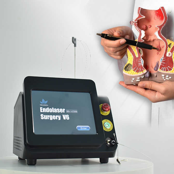 Hemorrhoid Treatment Laser Proctology Surgery 980nm 1470nm Diode Laser ...