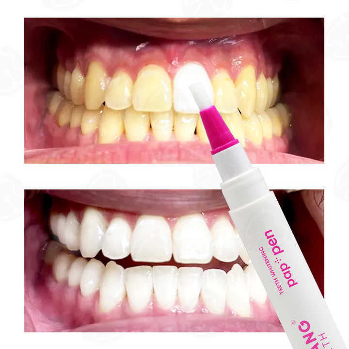 GT Teeth Whitening Pen - High Quality Dental Bleaching Gel