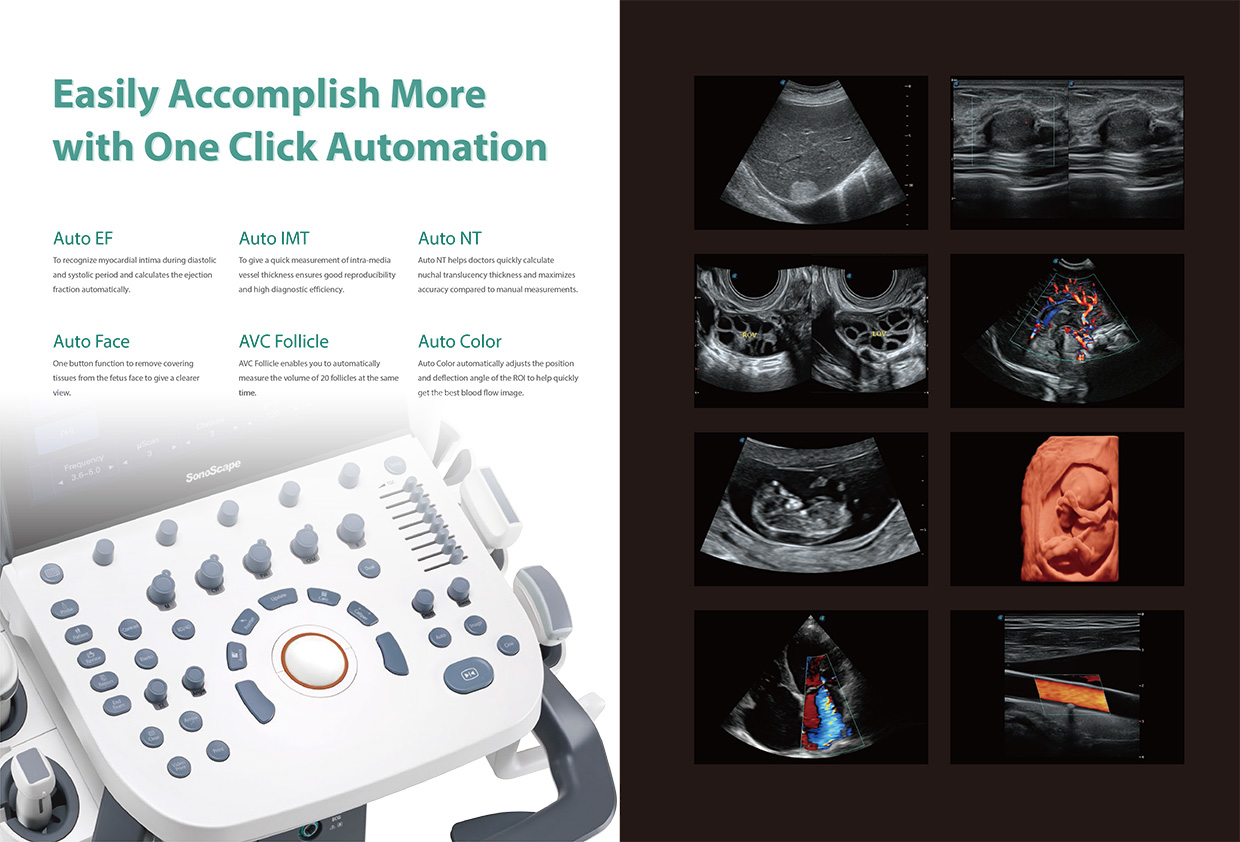 Sonoscape P20 3D |4D | 5D Ultrasound Color Doppler