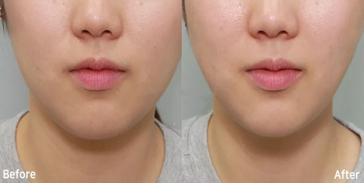 2023 7d Hifu Mpt With 10 Cartridges Hifu(high Intensity Focused ...