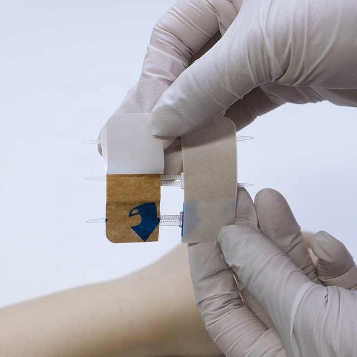 Trummed Non-Invasive Suture Zip Tie Wound Closure Zip Ties Without ...