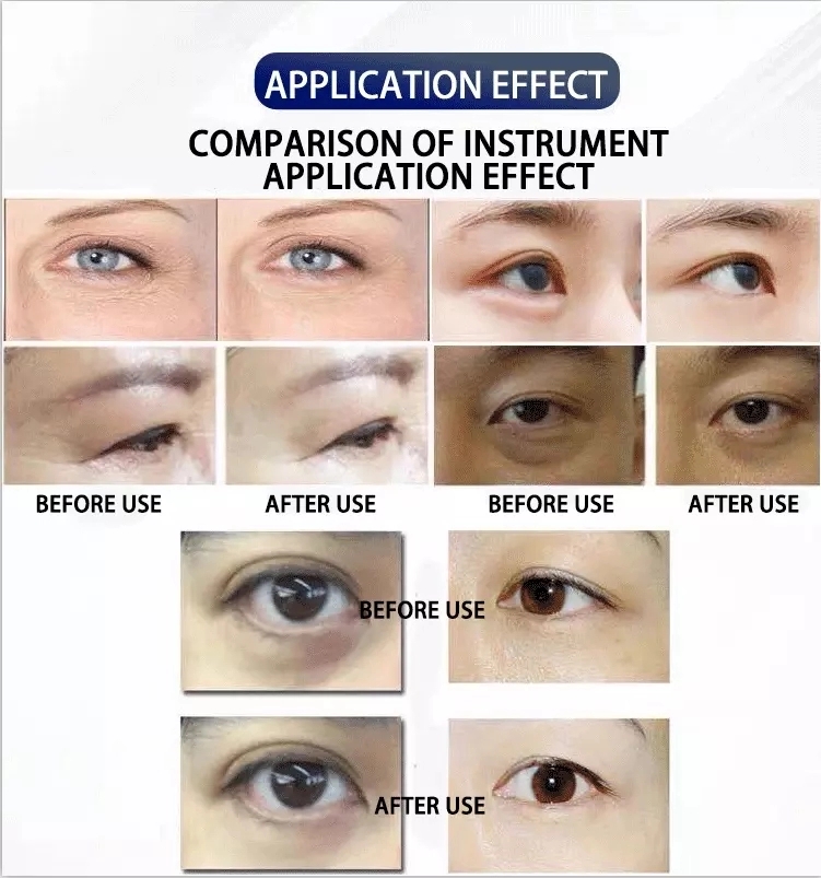 Smart Magic Eye Remove Wrinkles Anti-Agin Skin Tightening Gold Eye ...