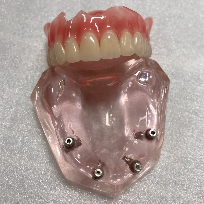 Resin Dental Overdenture Mandibular Implant Anatomical Model with 2 ...