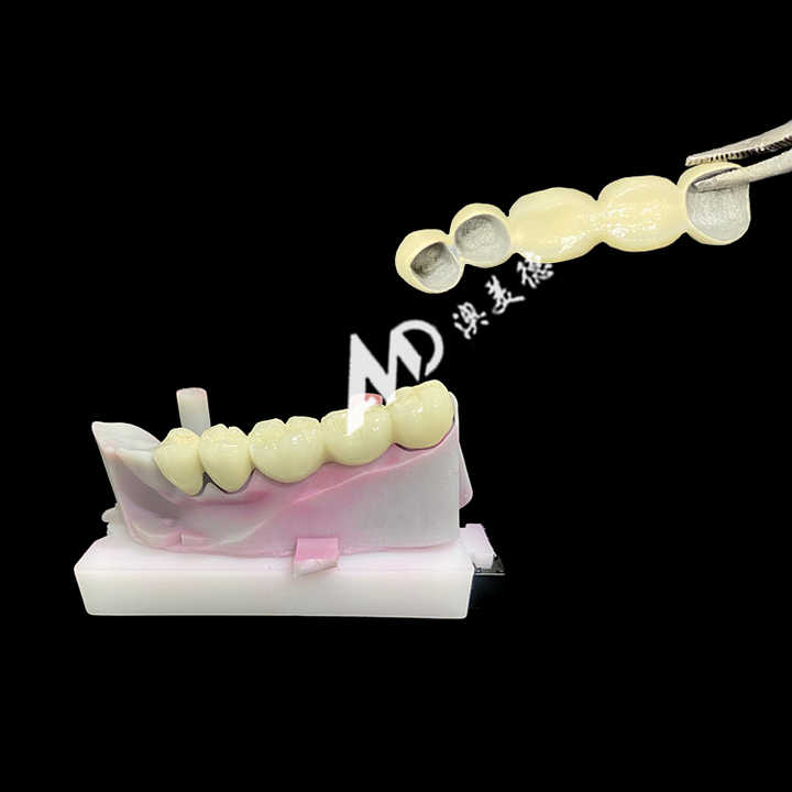 Reliable Porcelain Fused to Metal PFM Dental Bridge for Functional and ...