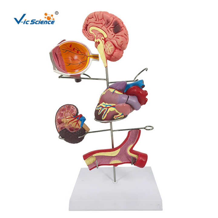 Hypertension Anatomy Model Set Biology Model Teaching Medical Science ...