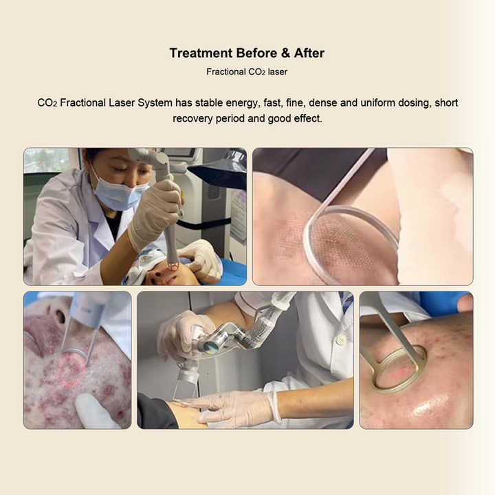 Ce Certified Fractional Co2 Laser Skin Resurfacing Machine New C02 ...