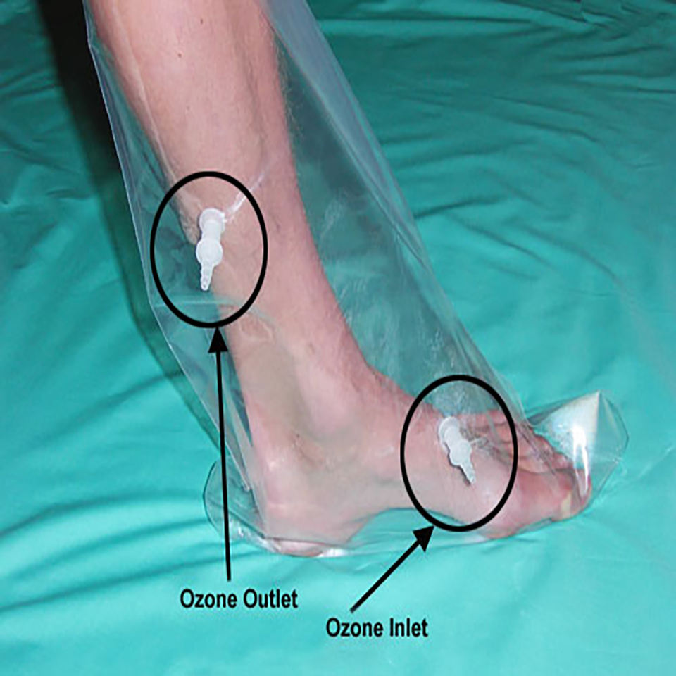O3 Limb Bag Ozone Bagging Treatment Ozone Limb Bags With Self-tapping ...