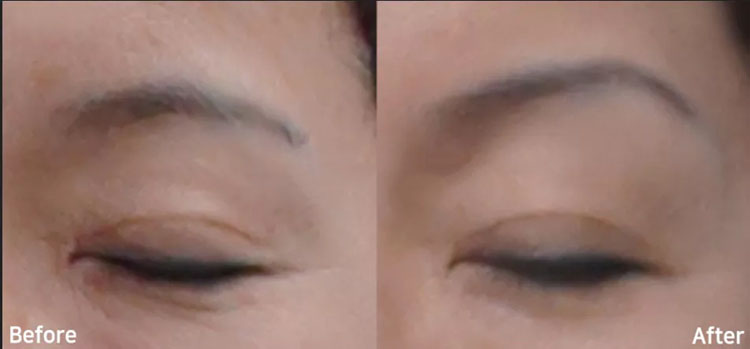 2023 7d Hifu Mpt With 10 Cartridges Hifu(high Intensity Focused ...