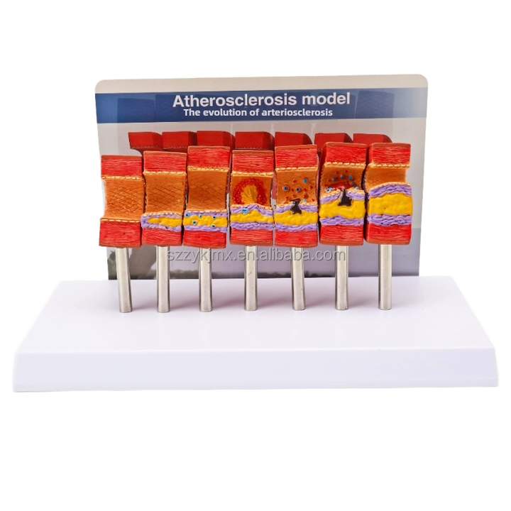 Atherosclerosis and Thromboembolism Model Human Medical Science ...