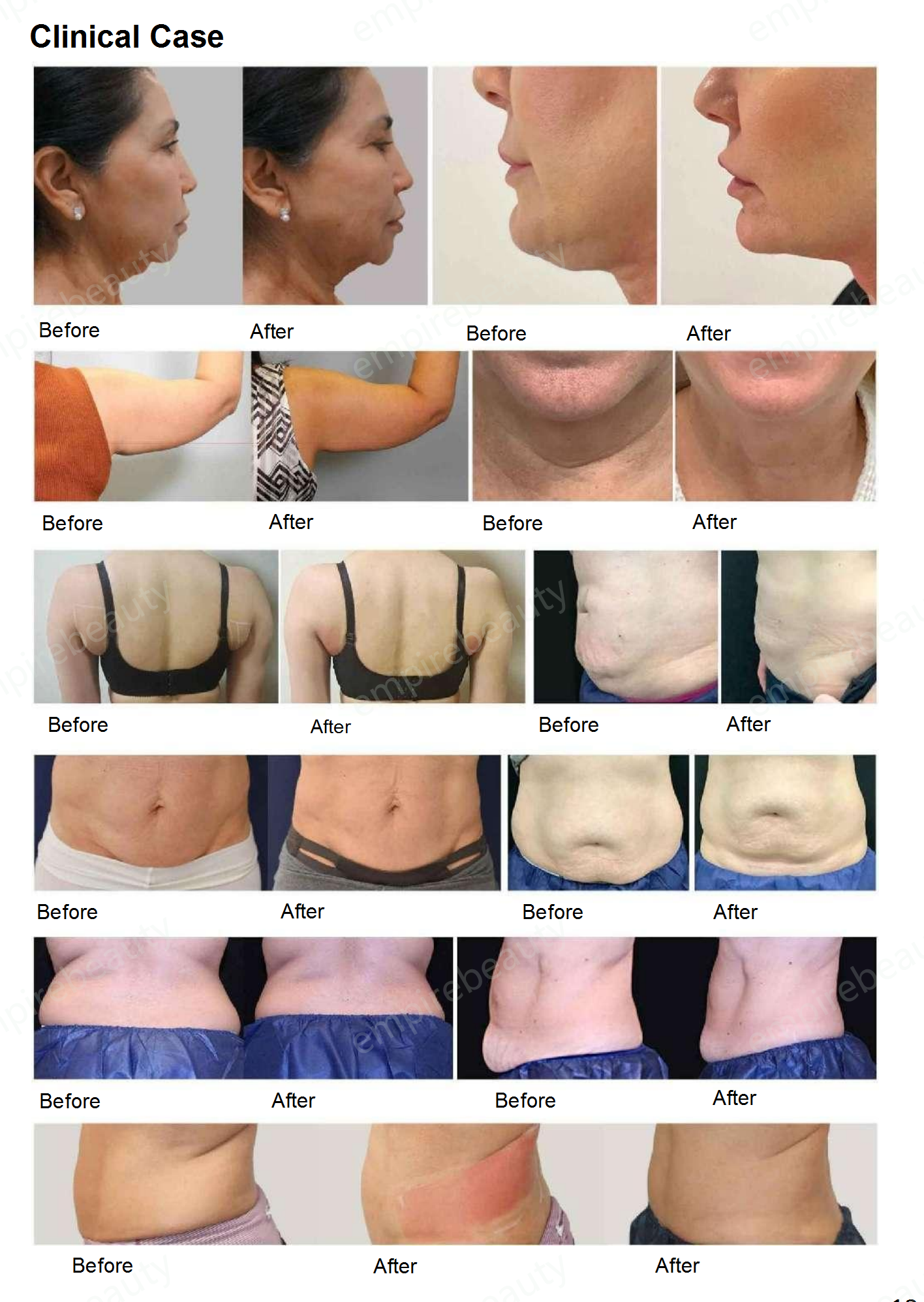 2022 Latest Full Body Fat Removal Machine Warm RF Sculpting TruSculpt 3D Tru Sculpt ID RF Monopolar Therapy