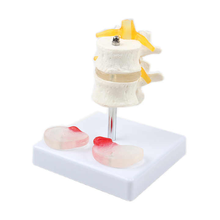 Educational Science Models - Lumbar Anatomy & Disc Herniation