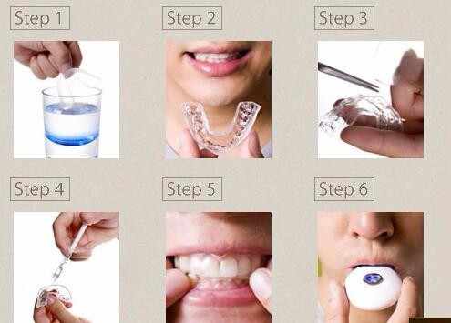 ai Orthodontic Clear Aligners for Dental Care - OEM/ODM | Wholesale