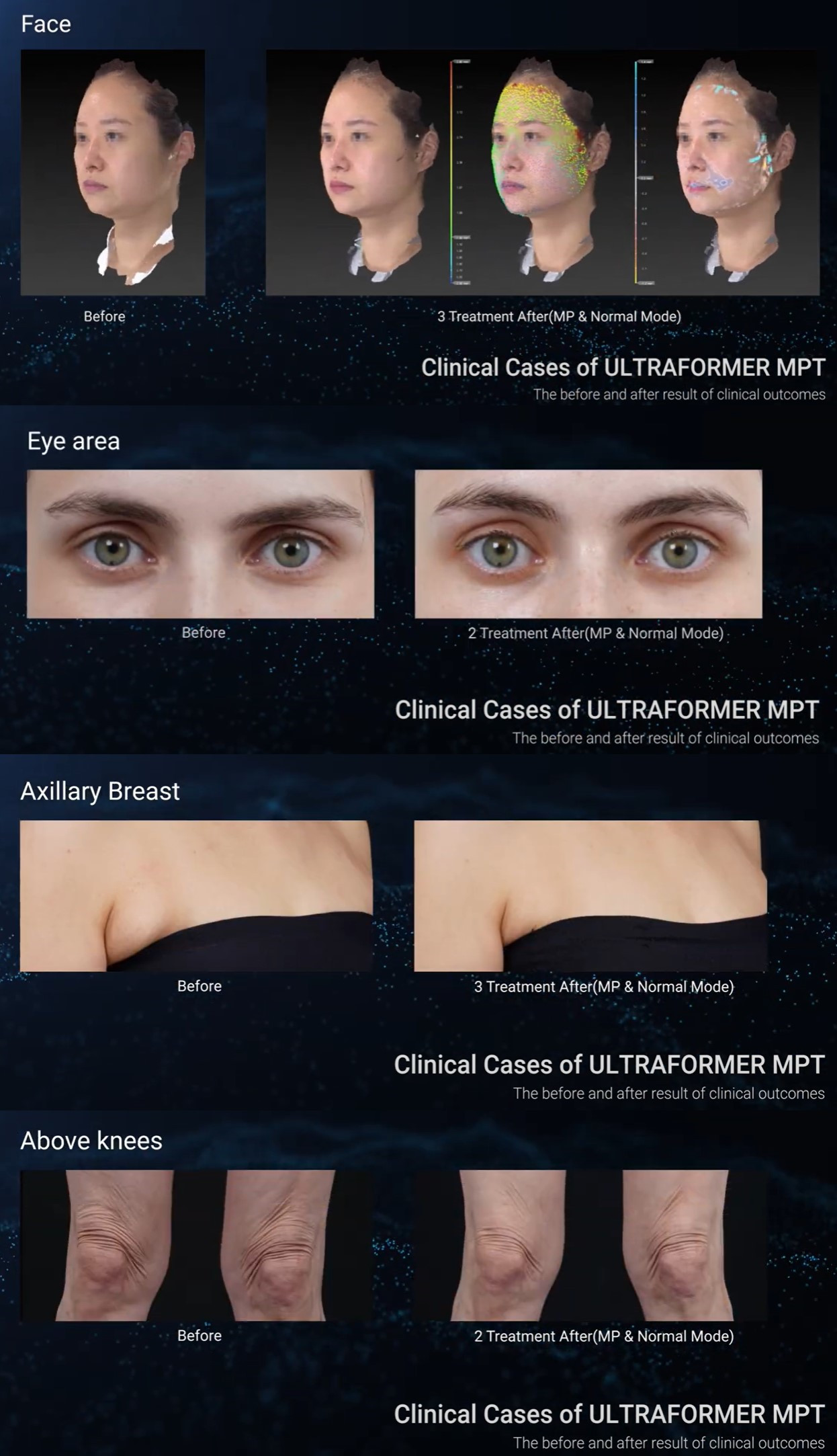 Latest HIFU Technology Ultraformer MPT MMFU 7D Ultraformer IV Face and ...