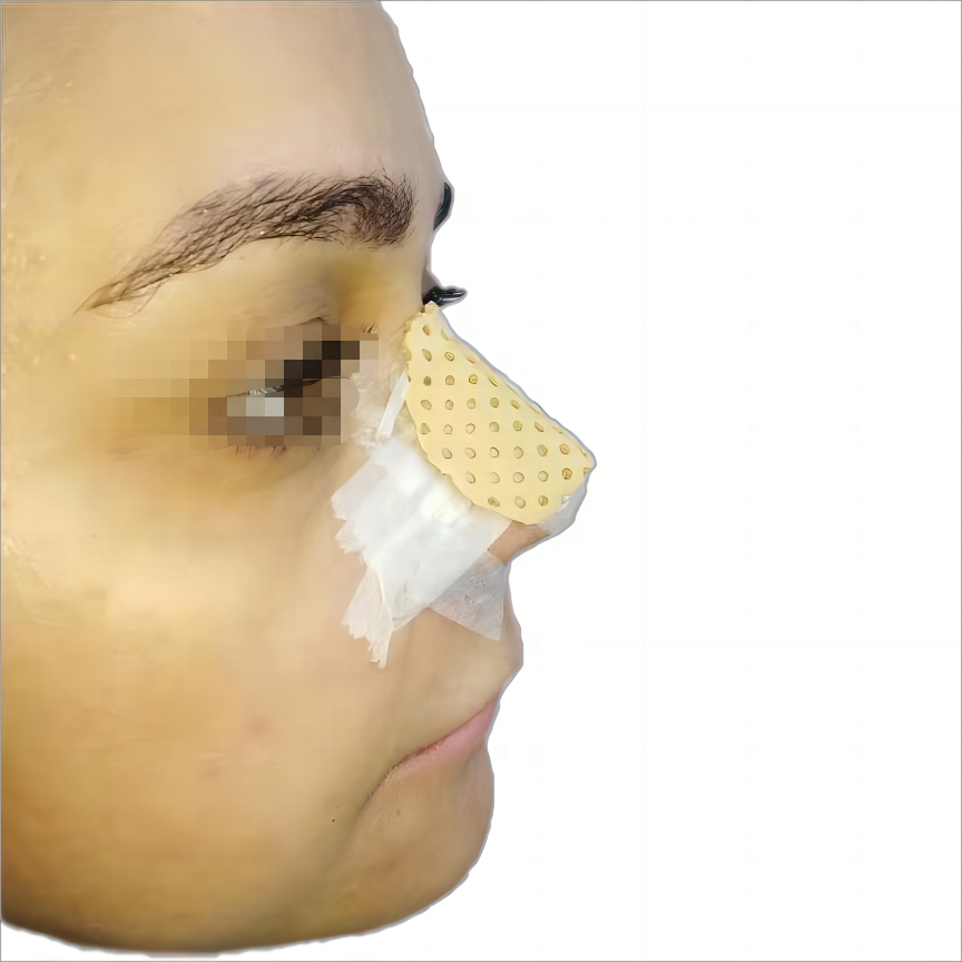 External Thermoplastic Nasal Splint for Nose Surgery