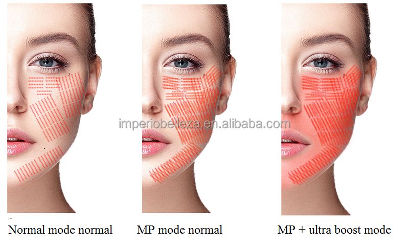 Latest HIFU Technology Ultraformer MPT MMFU 7D Ultraformer IV Face and ...