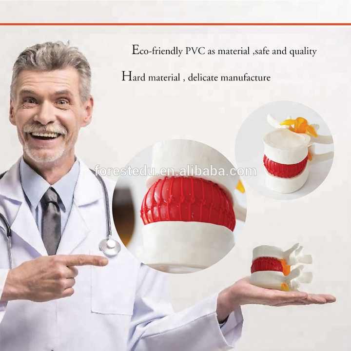 Lumbar Disc Herniation Model FRT039 - Educational Tool