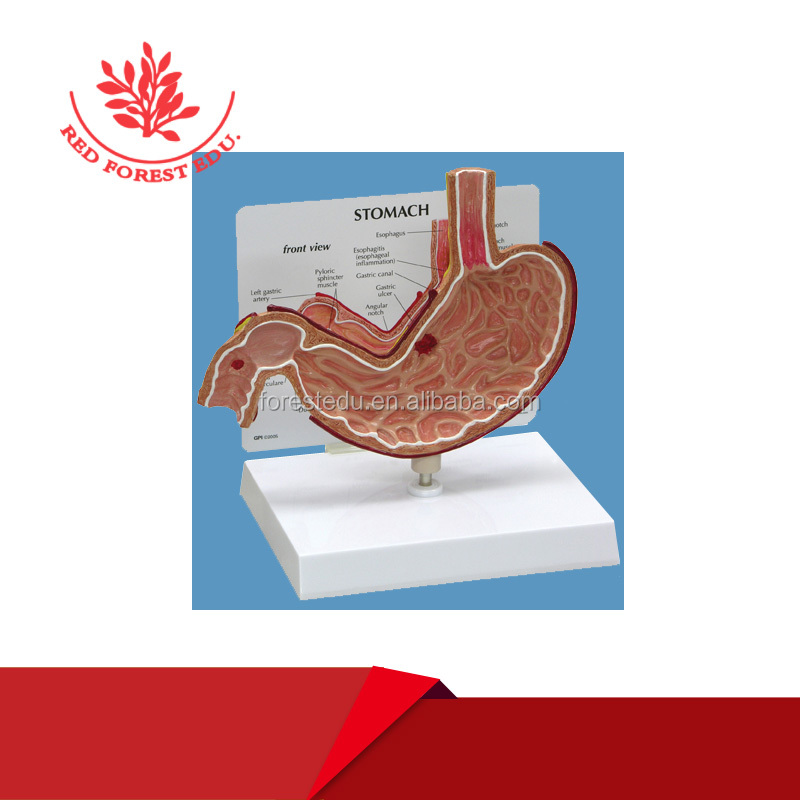 Diseased Stomach Model with Diaphragm Demonstration Model Pathological ...