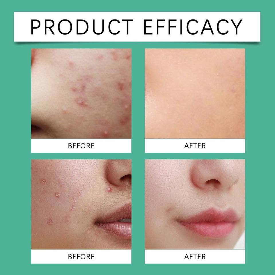 Korean Acne Patches Hydrocolloid Pimple Corrector for Deep Blemishes ...