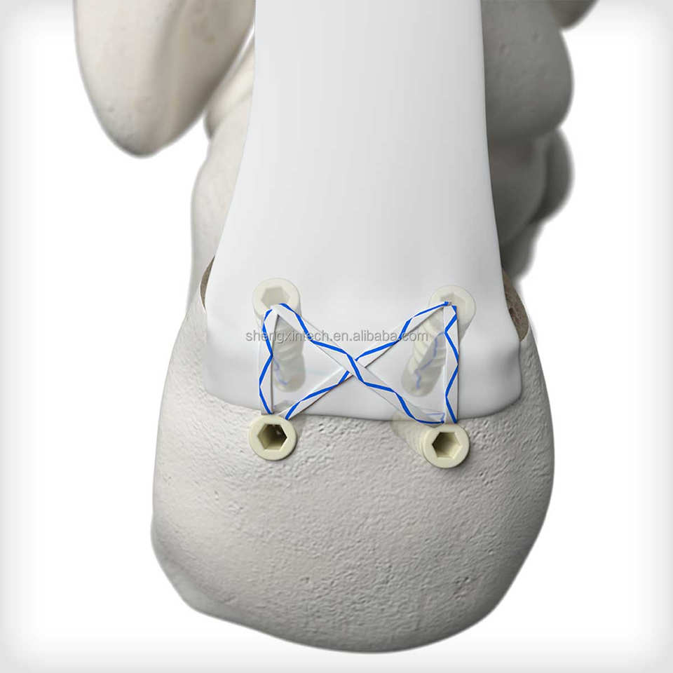 Sturdy Repair with UHMWPE Suture Tape for Tendon Tears