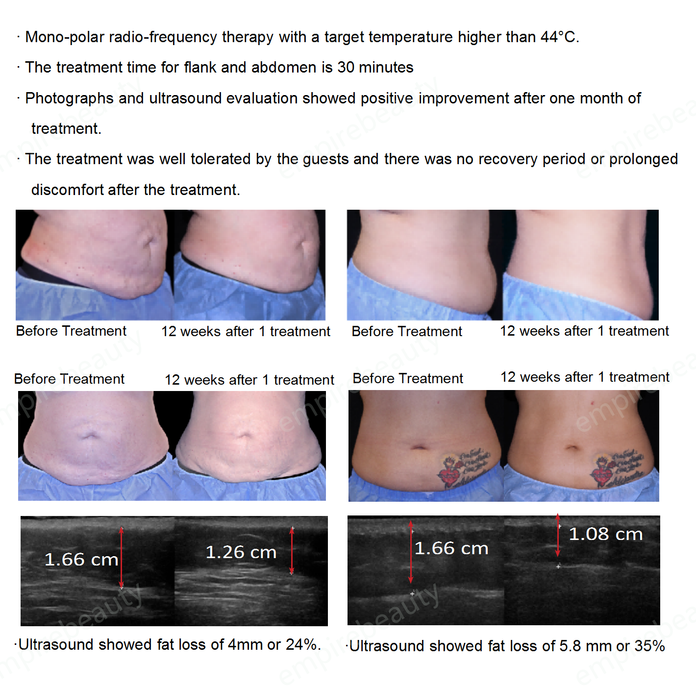 Non-surgical Fat Reduction Treatment TruScupt ID Fat Removal Machine ...