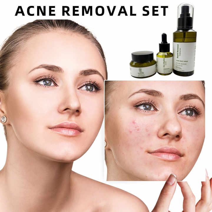 OEM Acne Skin Care Set Peroxide Acid Toner Pimples Repairing Cream Skin ...