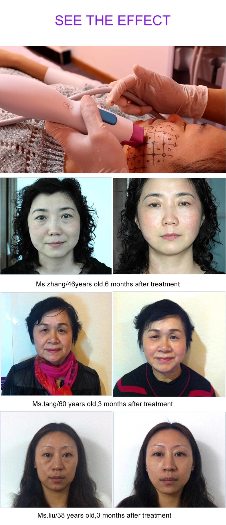 thermage rf Fractional Rf Microneedle Laser Treatment Machine Device ...