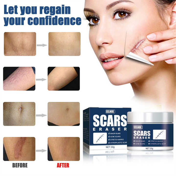 EELHOE Scars Eraser Minor Bum Acne Stretch Mark Removing No Scars Cream ...