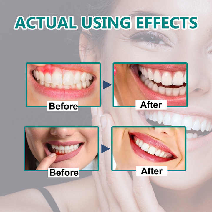 Gum Relief Drops - Inflamed Overgrown Bleeding Gums Treatment